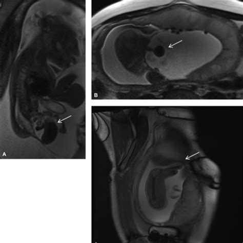 Reported Fetal Findings By Diagnosis Oeis Complexcloacal Exstrophy
