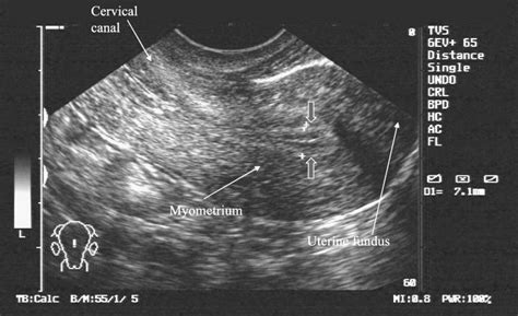 The Validity Of Transvaginal Ultrasound Measurement Of Endometrial