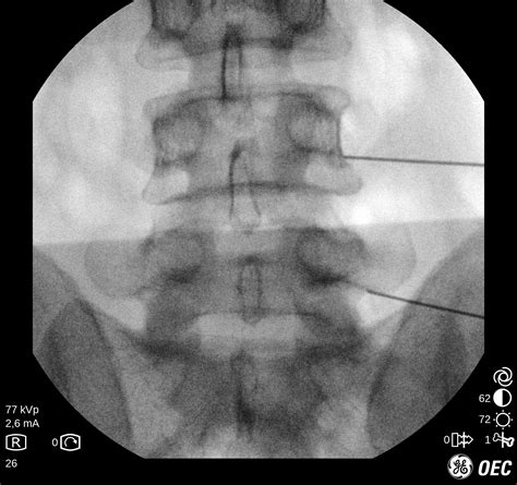 Spine Injections Arthrotech™