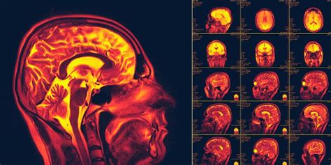 Neuroplasticity Definition Types Symptoms Stages And Significance Dr Satabdi Saha Mds