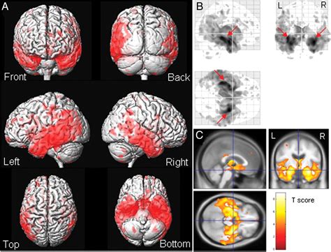 Voxel Based Morphometry An Automated Technique For Assessing