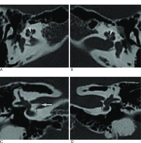 Cochlear Nerve Hypoplasia In An 8 Year Old Male With Right