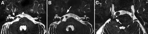 Mri Performed Six Months After Onset Of Right Sixth Nerve Palsy Axial