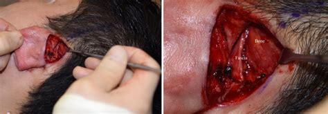 Five Concepts About Temporal Reduction Wide Head Narrowing Surgery Explore Plastic Surgery