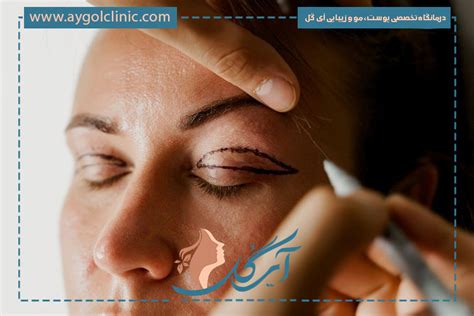 جدیدترین روش جراحی افتادگی پلک چیست و چگونه انجام می‌شود؟ آی گل