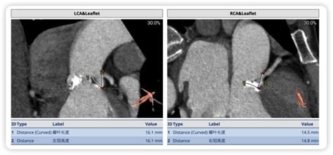 厦心医院成功完成全球首个polymer Tavr Sikeliaᵀᴹ高分子经股主动脉瓣介入置换系统的临床试验植入 严道医声网