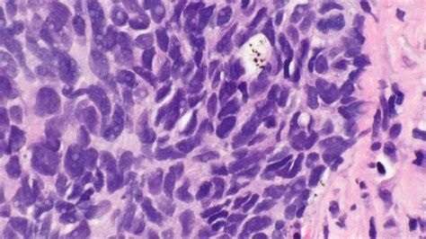 Triple Therapy For Squamous Nsclc Shows Real World Clinical Benefit R Nsclc