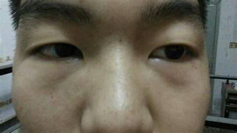 眼角水肿图片 眼角肿的图片 大山谷图库