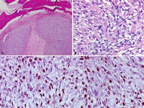 Microscopic Findings Typical Ossifying Fibromyxoid Tumor Ofmt A Download Scientific