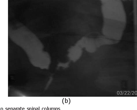 Successful Separation Of Conjoined Pygopagus Twins In Africanenvironment With Limited Resources