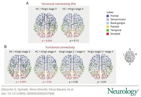 Mri Connectomics Als Edoardo Gioele Spinelli