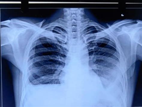 X Ray Erect Abdomen Post Ercp To Confirm The Position Of The Stent