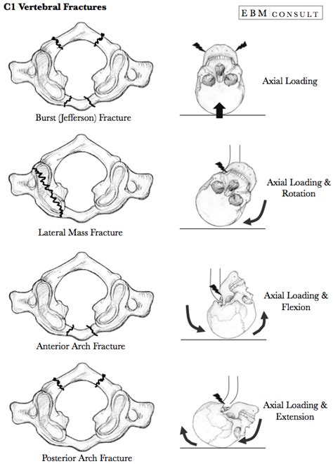 Jefferson Fracture Classification C1 Vertebral Jefferson Fractures