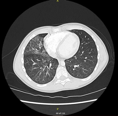 Bronchial Artery To Pulmonary Artery Fistula Presenting With Massive Hemoptysis In A Pediatric