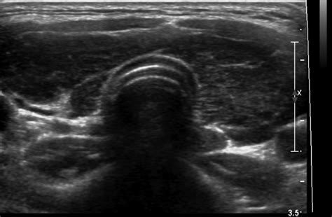 Ultrasonography Of The Thyroid Heterogeneously Low Echo Texture At Download Scientific Diagram