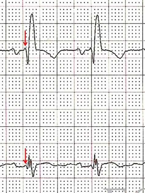 Right Bundle Branch Block ECG Guru Instructor Resources