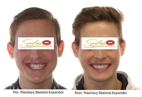 Maxillary Skeletal Expander Mse Katy Tx Smiles On Orthodontics