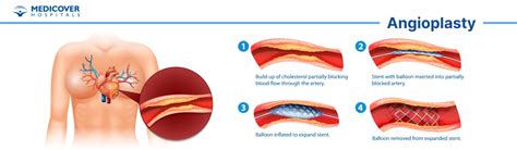 Angioplasty Steps Indications Risks And Recovery