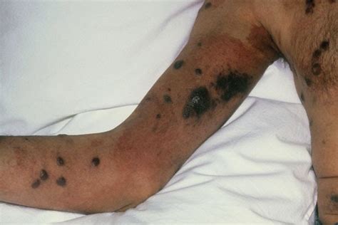 Kemaluan Anda Berlendir Bengkak Dan Pedih Apa Itu Penyakit STD Sexual Transmitted Disease