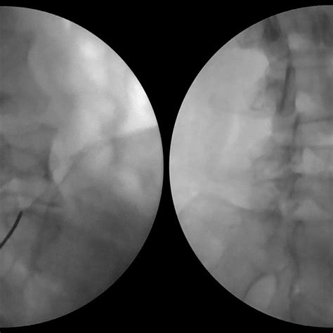 The Final Parallel Placement Of The Cryoprobe To The L4 L5 Facet Joint