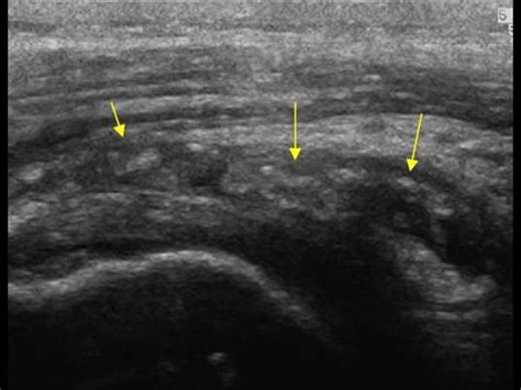 Musculoskeletal Joints And Tendons 61 Shoulder Case 6118 Bursa