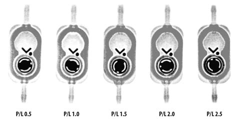 Ventricular Shunt Reference The Neurosurgical Atlas By Aaron Cohen Gadol M D