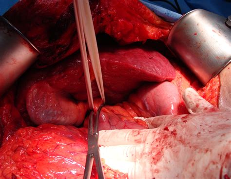 Segmental Oriented Liver Surgery Intechopen