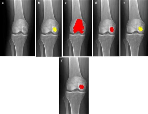 a input image b fcm segmented image c active contour segmented image