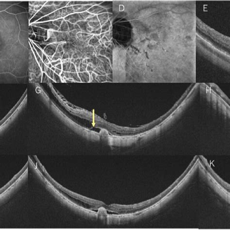 A 66 Year Old Woman With An Axial Length Of 28 63 Mm Myopic Choroidal