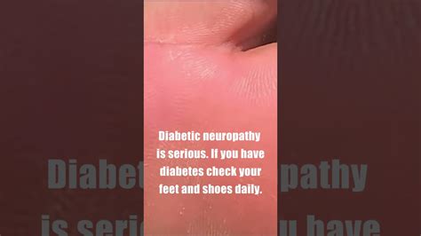 Diabetic Neuropathy Is Serious Business Diabetes