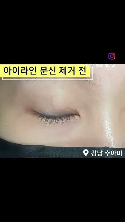 깨끗한 눈 퓨어하게 제거 장인 강남 수아미 아이라인제거 아이라인문신제거 피코레이저 Youtube