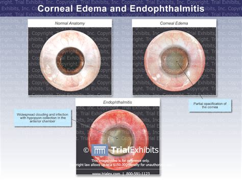 Corneal Edema And Endophthalmitis Trialquest Inc