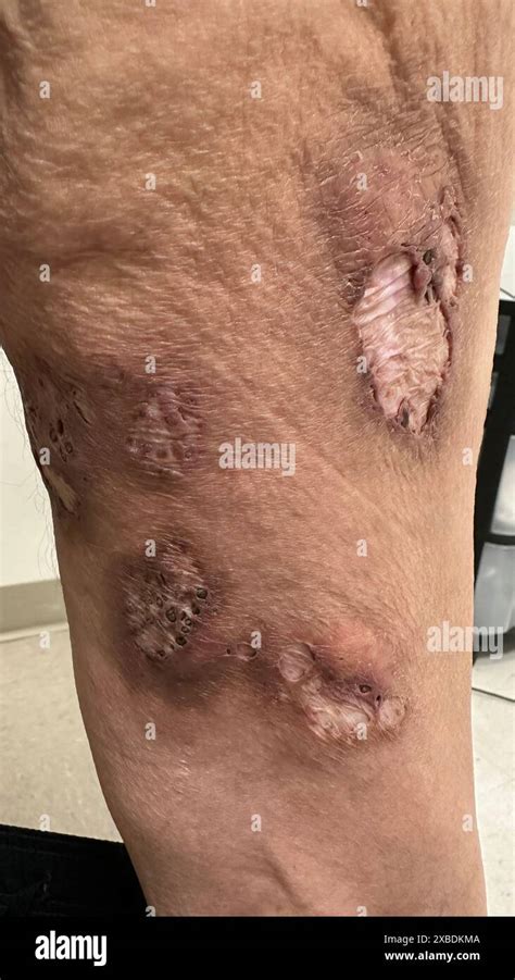 Healing Pyoderma Gangrenosum Lesions On The Skin Of A Patient Who Is