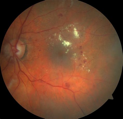 Diabetic Retinopathy Classification Dataset And Pre Trained Model By Diabetic Retinopathy