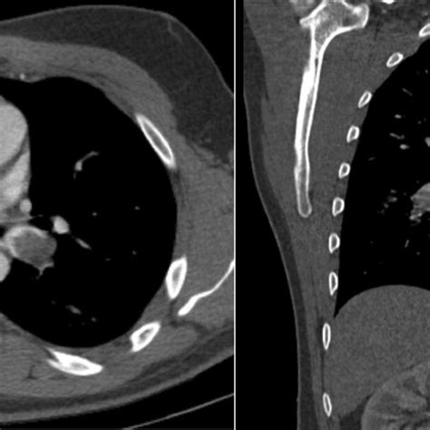 Ct Scans In All Planes With 3d Rendering Demonstrate Severe Compression Download Scientific