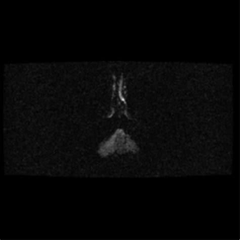 Choroid Plexus Papilloma Radiopaedia Axial DWI NC Commons
