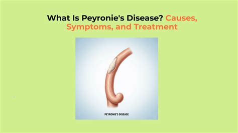 What Is Peyronies Disease Causes Symptoms And Treatment