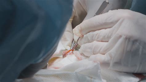 Doctors Perform Operation To Remove Appendix Stock Footage Sbv 348442599 Storyblocks