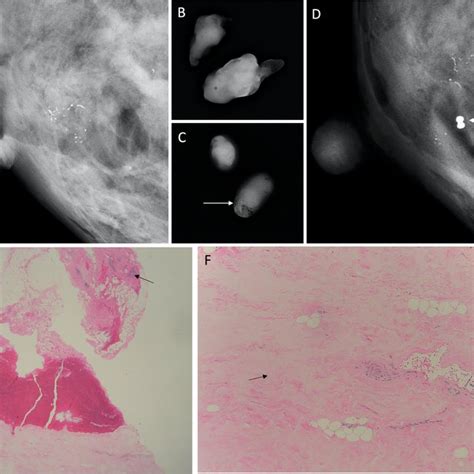 Group Of Pleomorphic Calcifications Spot Magnification True Lateral Download Scientific