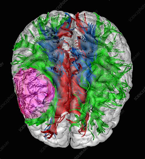 Brain Lesion Dti Mri Scan Stock Image C057 9208 Science Photo Library