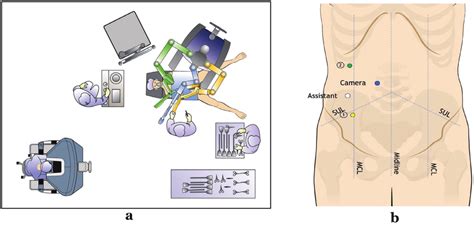 Operating Room Setting A And Trocars Used B For Splenic Flexure Download Scientific Diagram