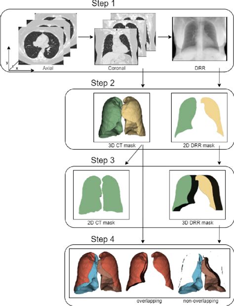 underestimation of lung regions on chest x ray segmentation masks