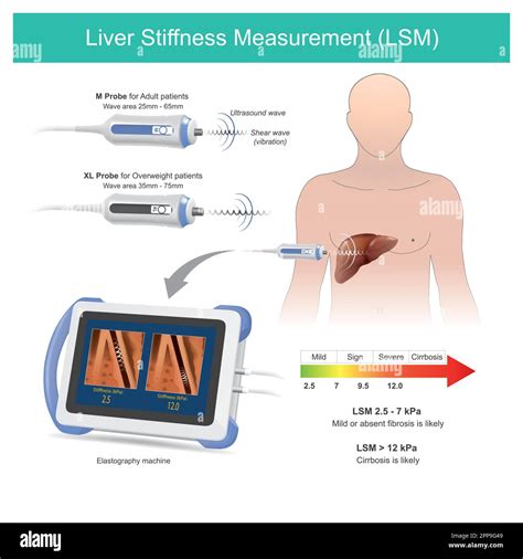 Liver Stiffness Measurement Measuring Tissue Liver Stiffness In Patients By Using The