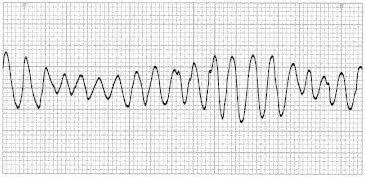 ACLS Strips Flashcards Quizlet