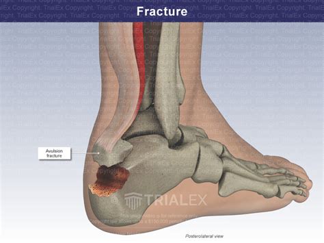 Avulsion Fracture Ankle