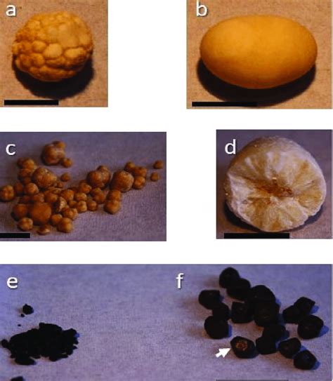 Human Gallbladder Stones Pure Cholesterol Stones With Spherical Shape
