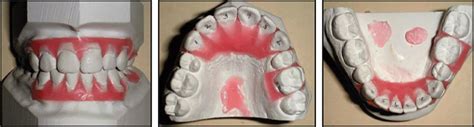 Premolar Extraction In Adult With Aligners
