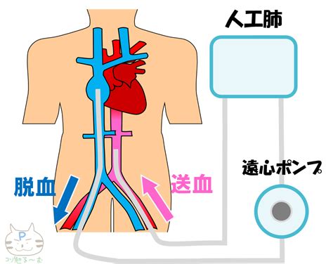 Ecmo，pcpsって何？【原理からわかりやすく解説】 循環器drぷーのコソ勉る〜む