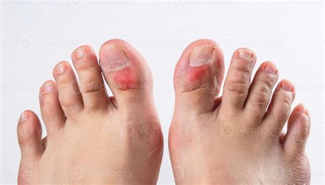 Close Up Of Chilblains On Toes With Swollen Red And Itchy Skin