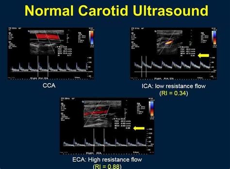 Three Different Views Of Normal Cardioid Ultrasound And Eca High Resistance Flow